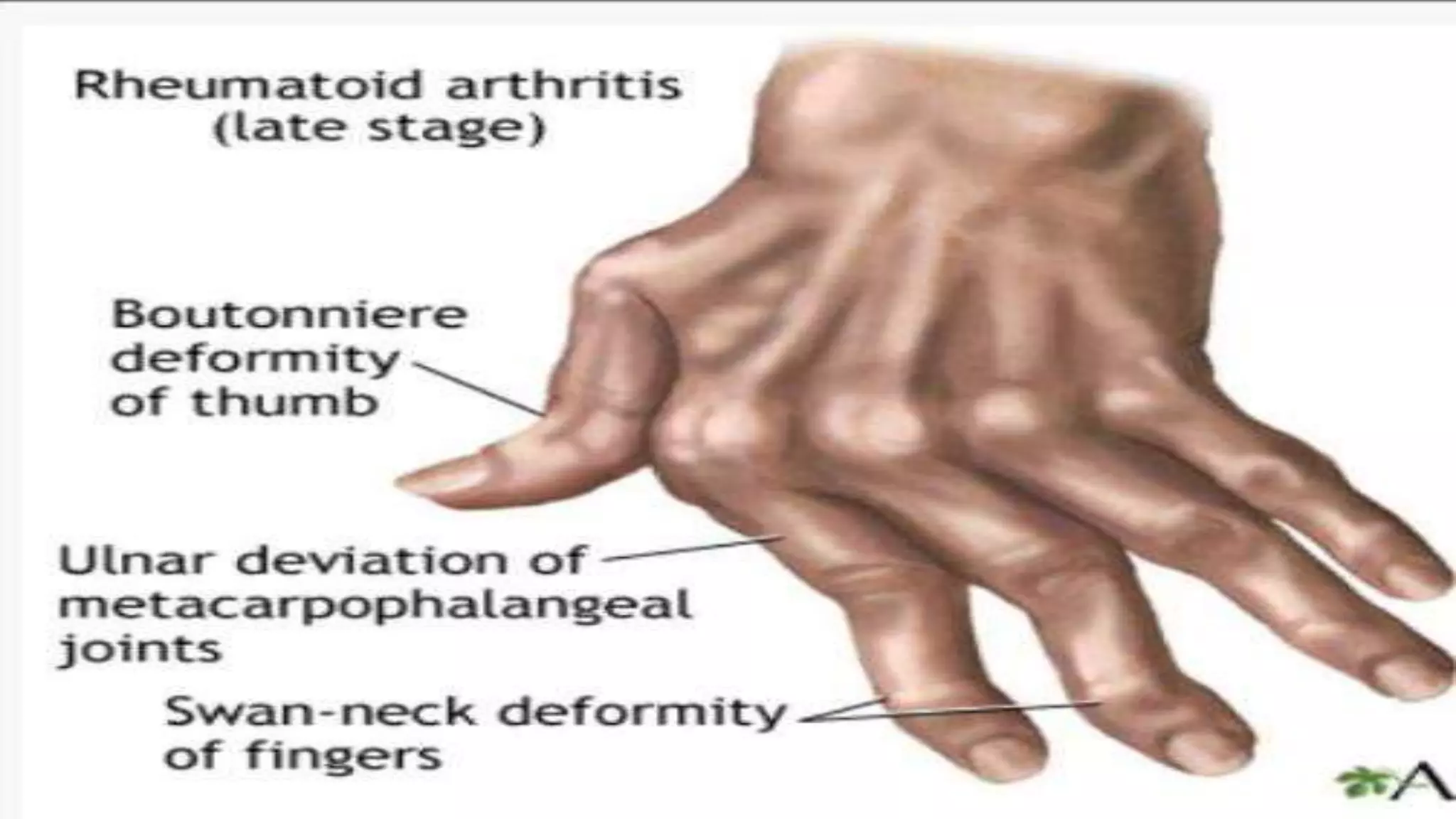 Rheumatoid arthritis For G.N.M 2nd & B.Sc.2nd & 3rd Year Nursing ...
