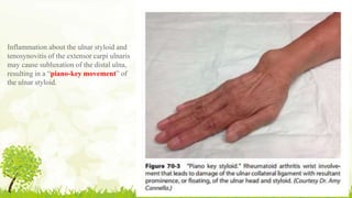 Rheumatoid arthritis | PPT