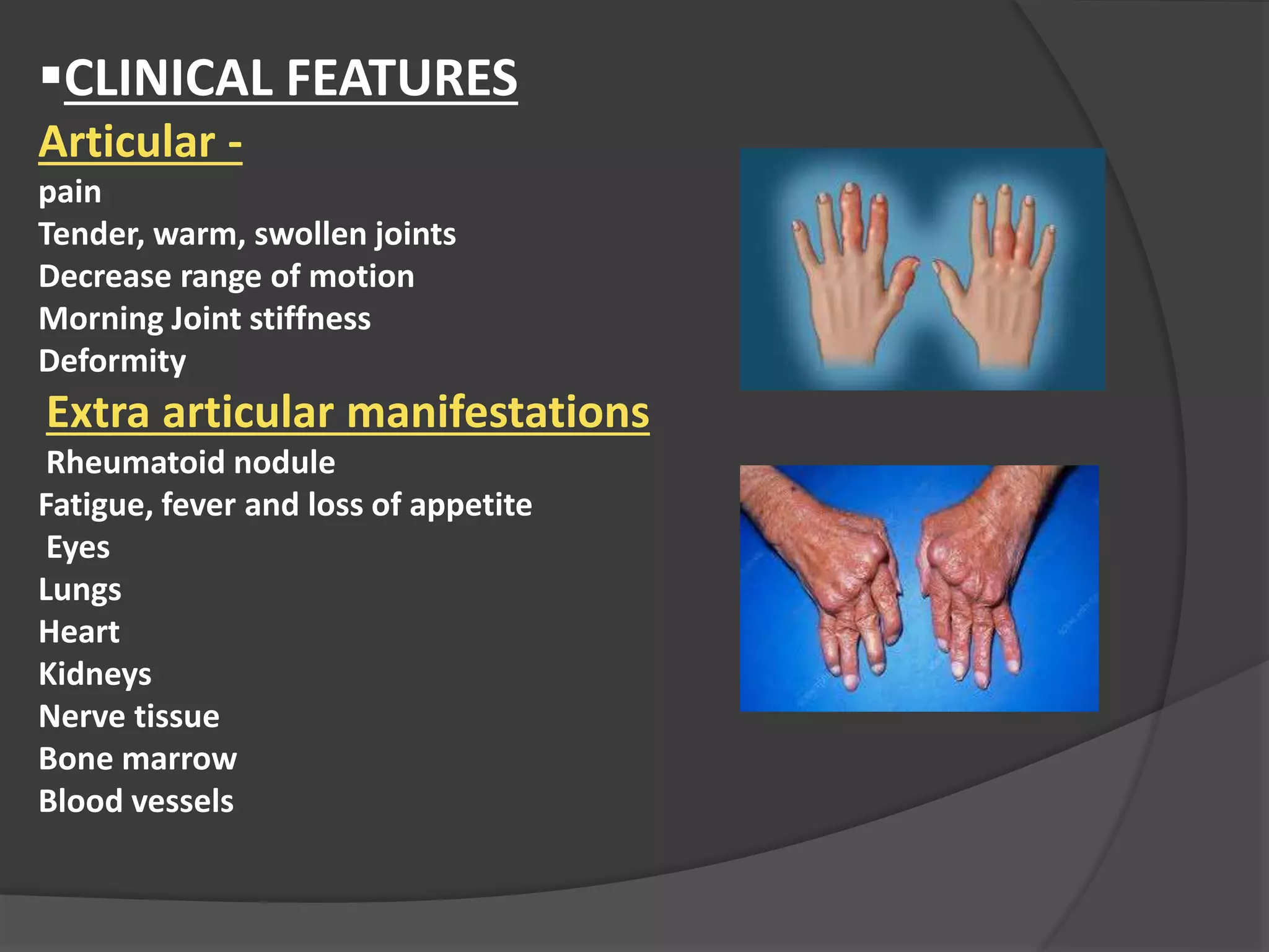 Rheumatoid arthritis | PPTX