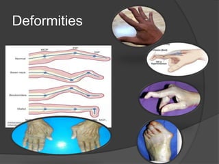 Rheumatoid arthritis | PPTX