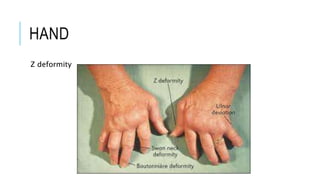 Rheumatoid arthritis - Dr. Saaralsenthil91 | PPT