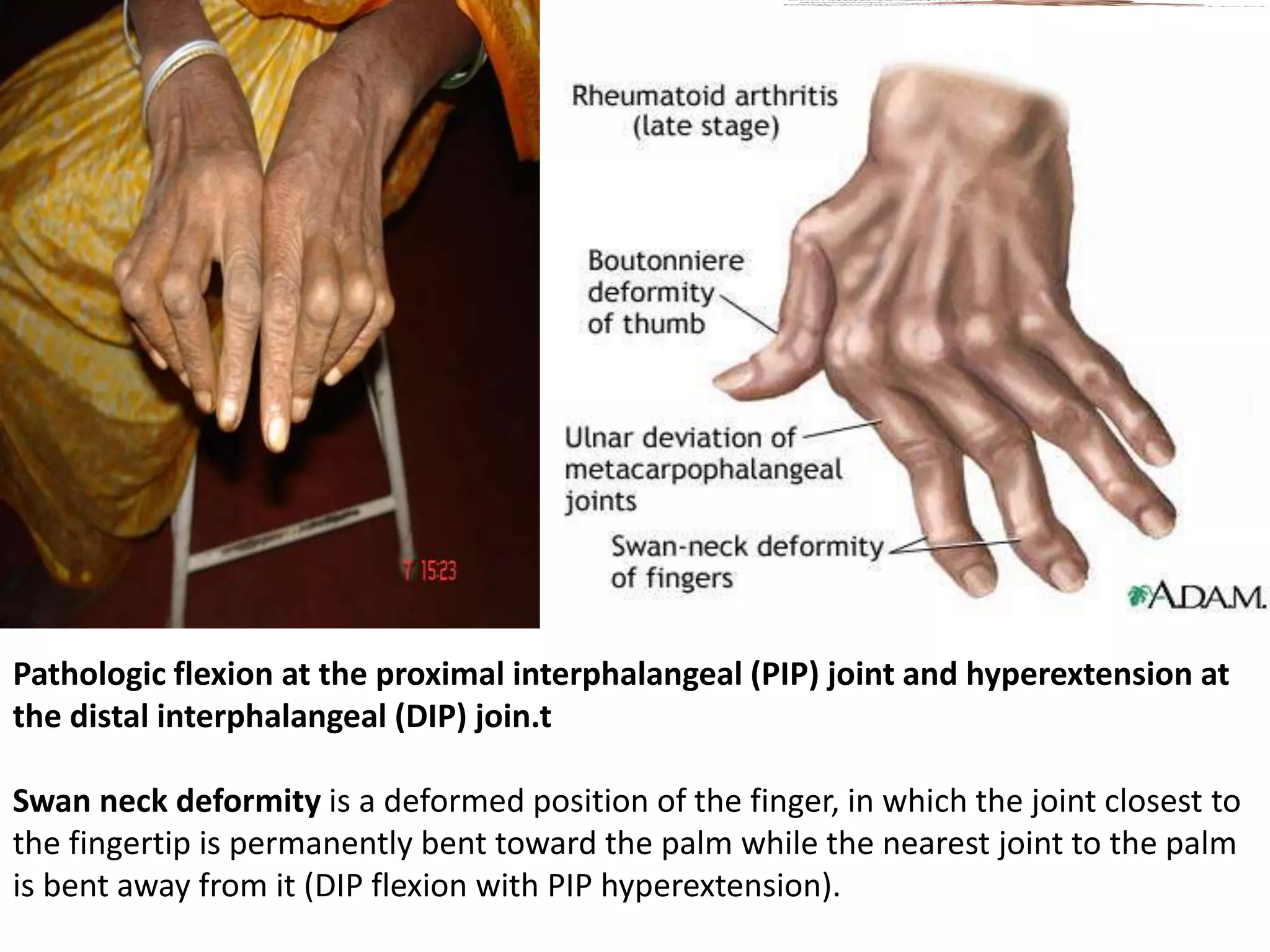 Rheumatoid arthritis | PPT