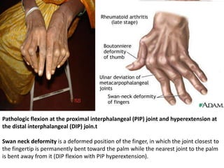 Rheumatoid arthritis | PPTX