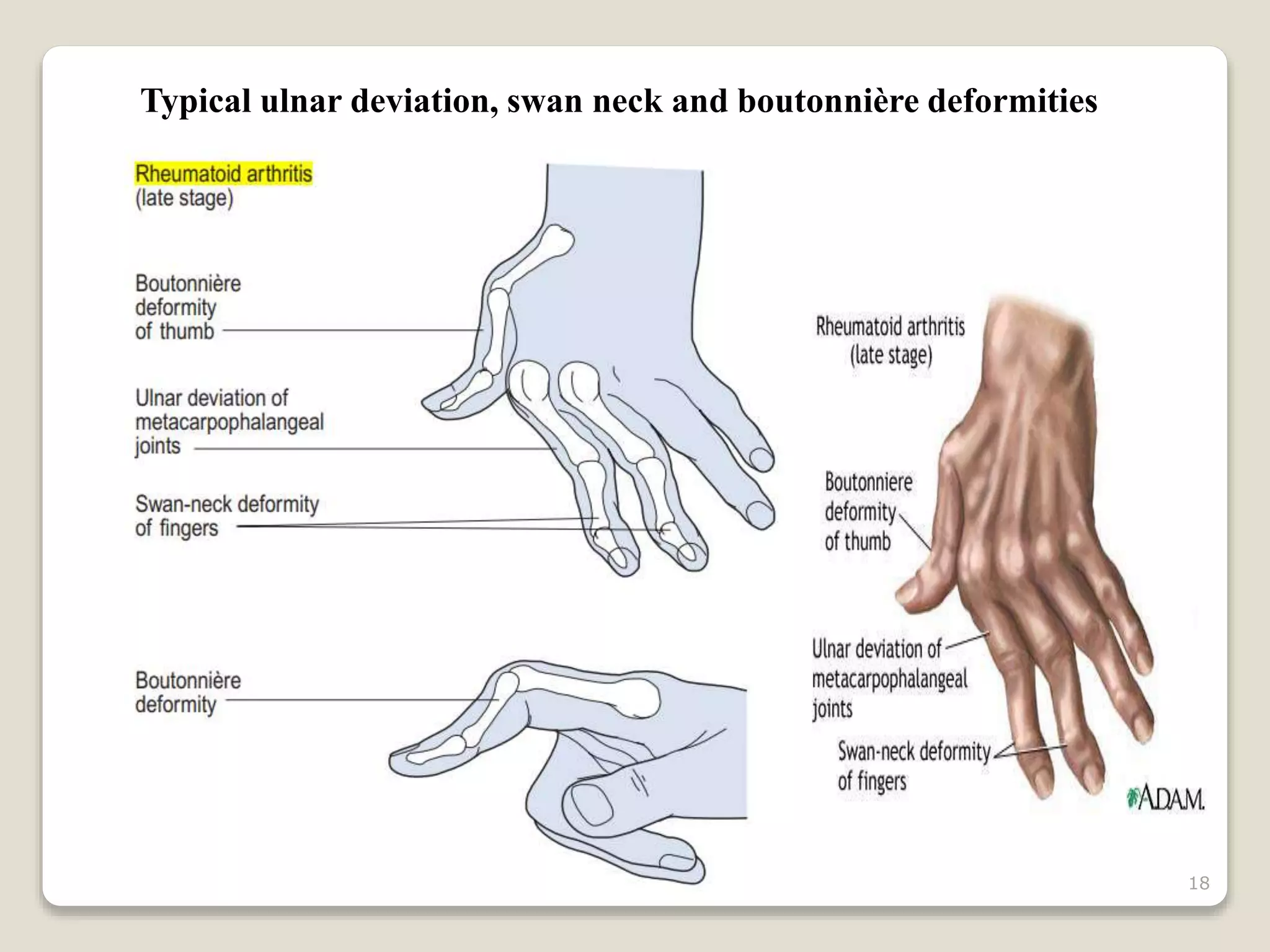 RHEUMATOID ARTHRITIS.pptx