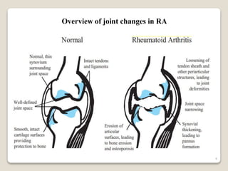 RHEUMATOID ARTHRITIS.pptx