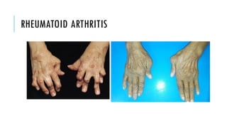 Rheumatoid Arthritis.pdf