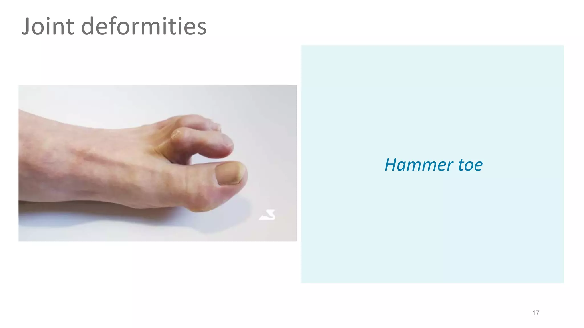 Rheumatoid Arthritis.pptx