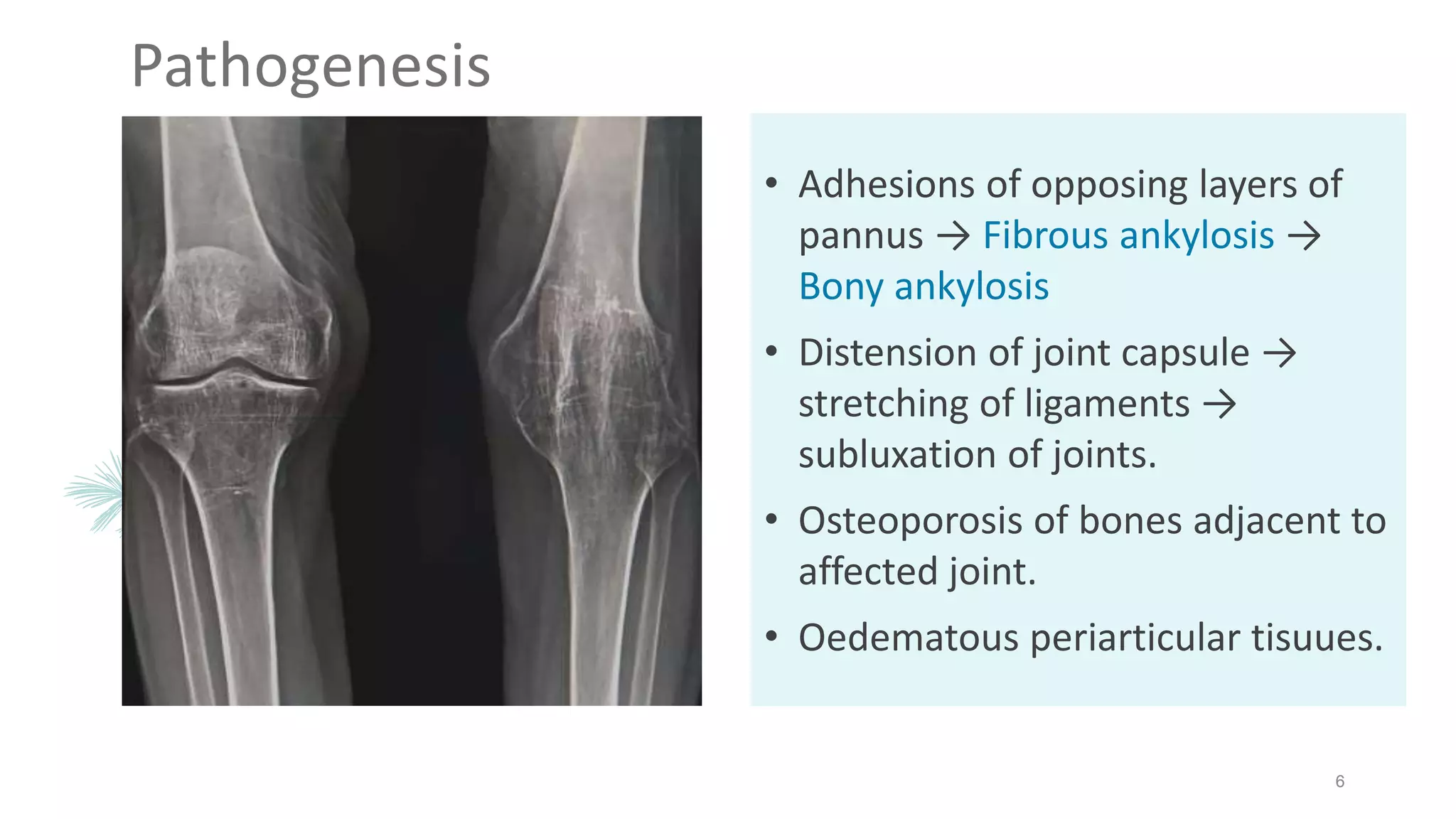 Rheumatoid Arthritis.pptx