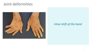 Rheumatoid Arthritis.pptx