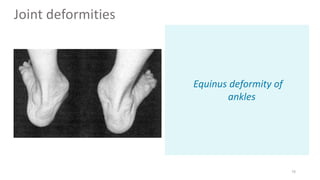 Rheumatoid Arthritis.pptx