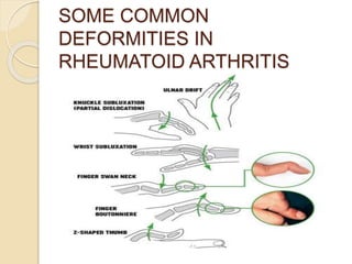 RHEUMATOID ARTHRITIS | PPTX