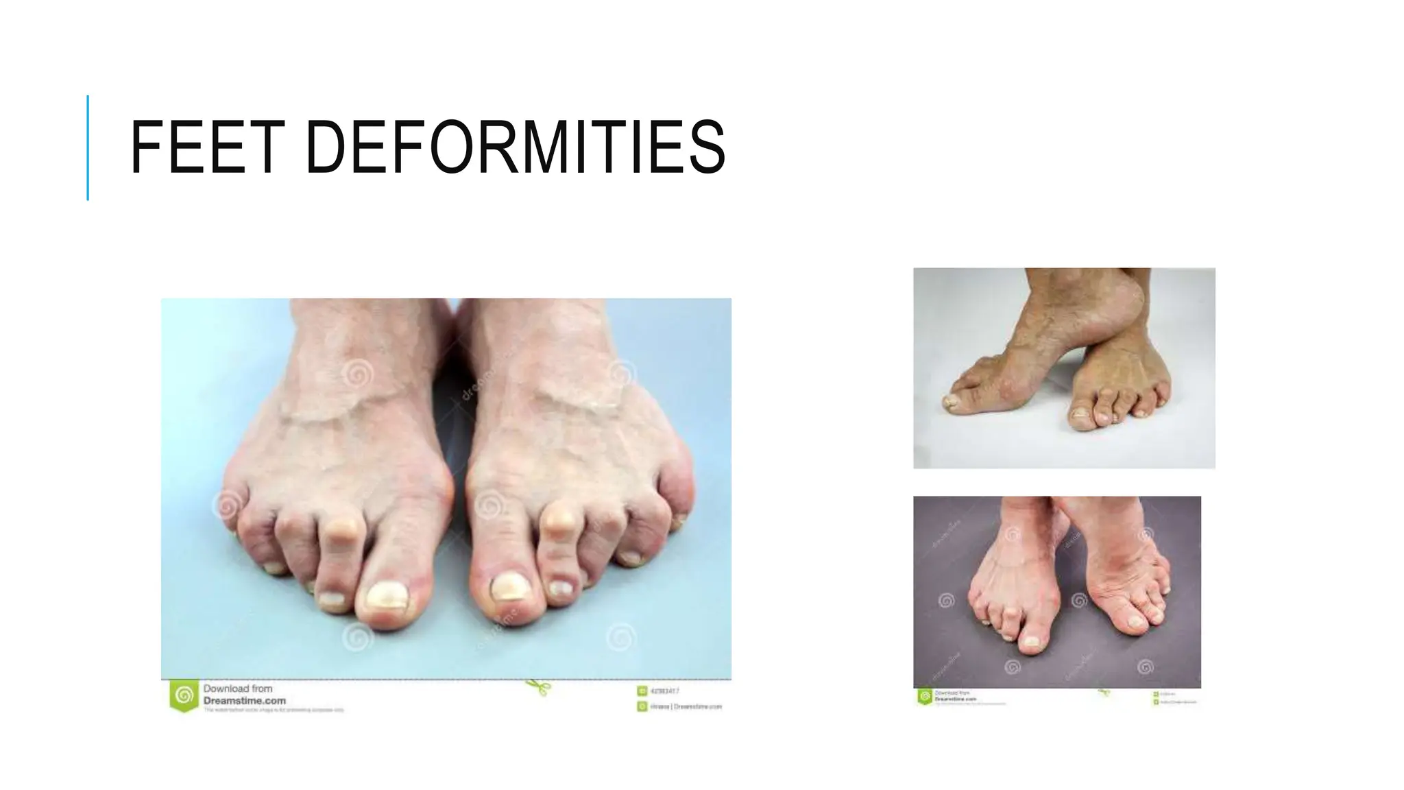 Rheumatoid Arthritis.pptx