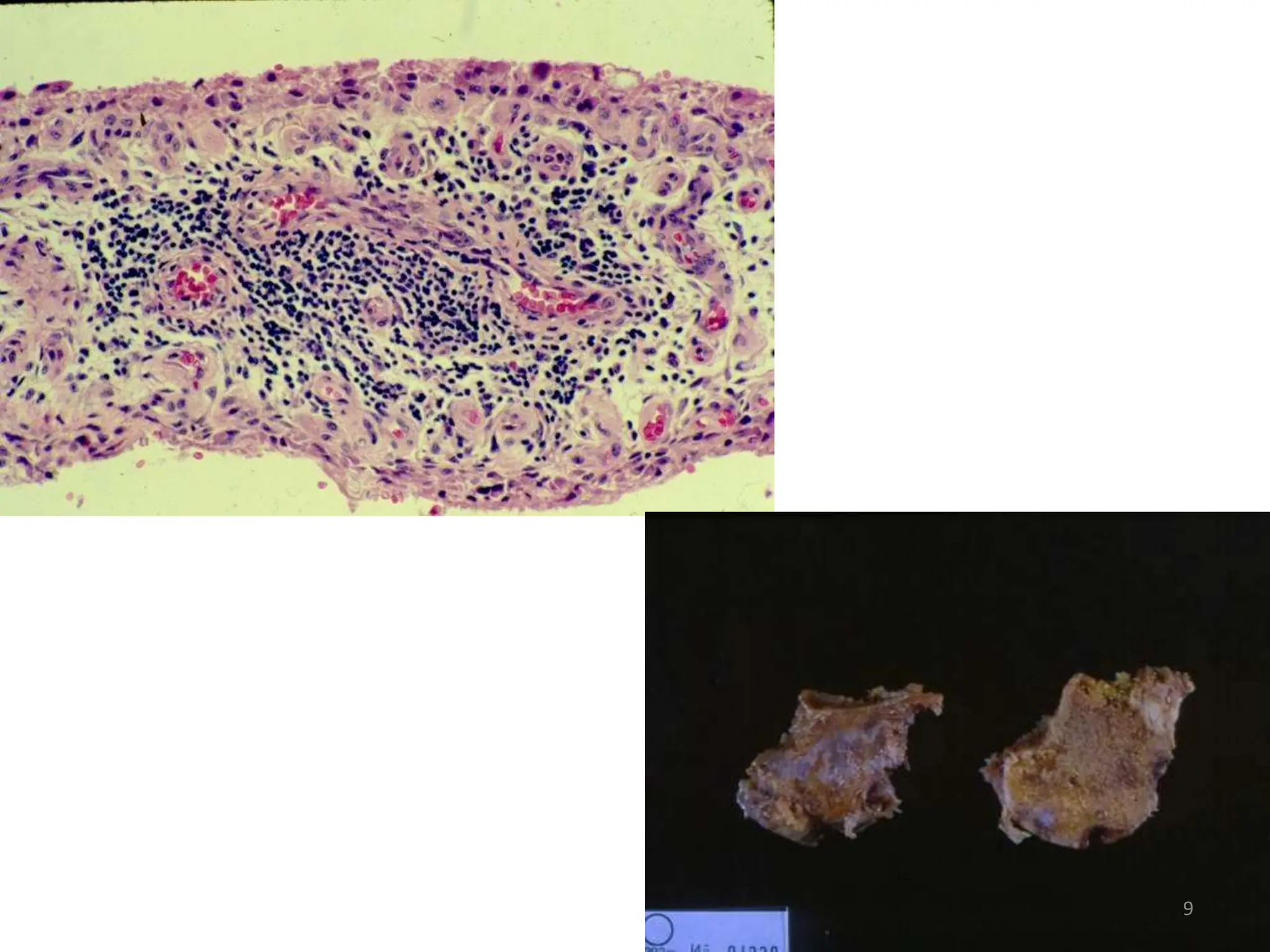 Rheumatoid Arthritis Pathology, C/F and Diagnosis and Mx.ppt