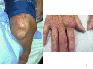 Rheumatoid Arthritis Pathology, C/F and Diagnosis and Mx.ppt