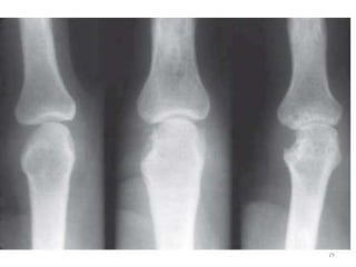 Rheumatoid Arthritis Pathology, C/F and Diagnosis and Mx.ppt