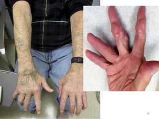 Rheumatoid Arthritis Pathology, C/F and Diagnosis and Mx.ppt
