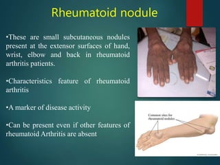 Rheumatoid Arthritis for Medical and Pharmacy Students | PPT