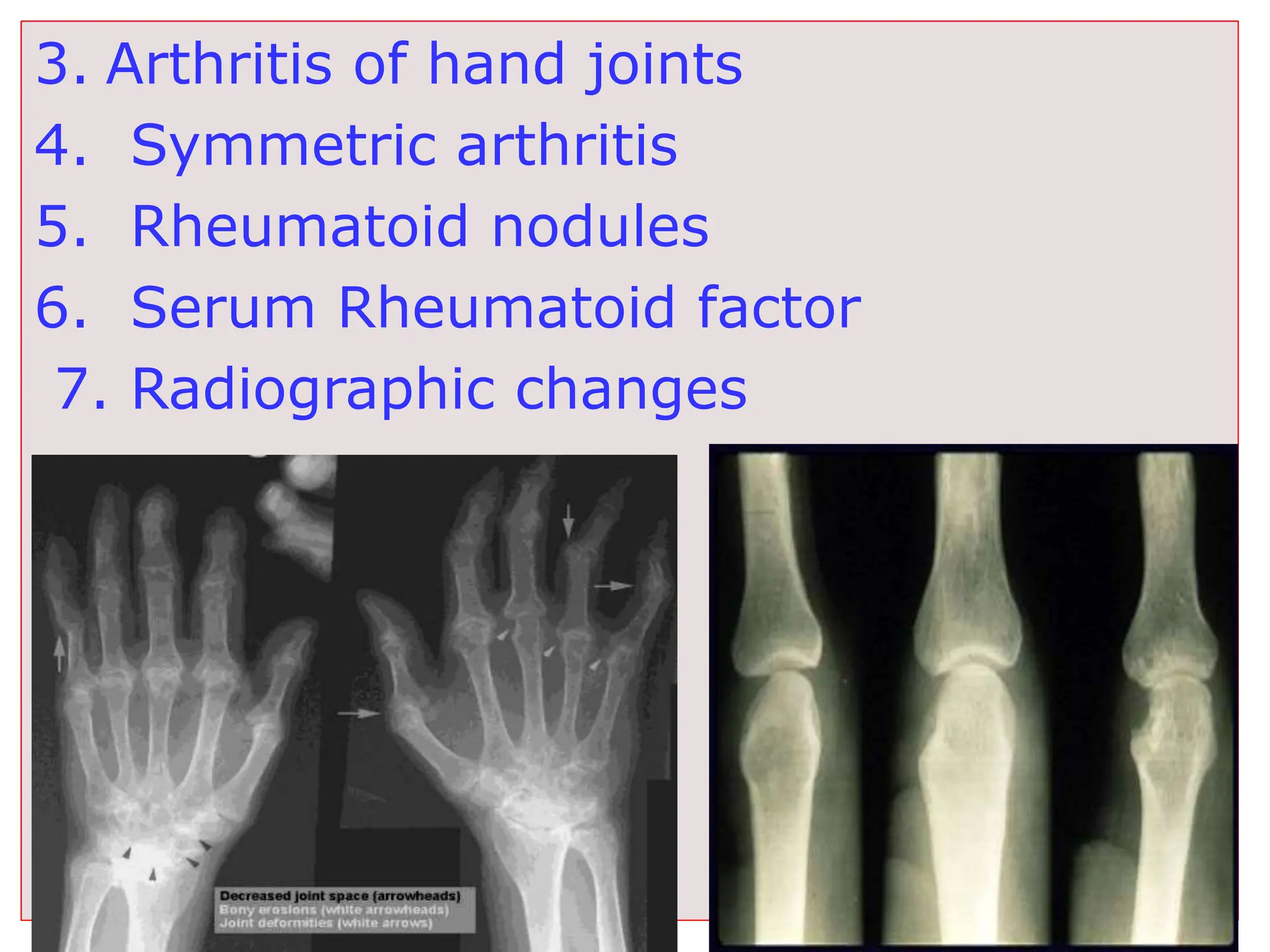 Rheumatoid arthritis - Musculoskeletal disorders.ppt