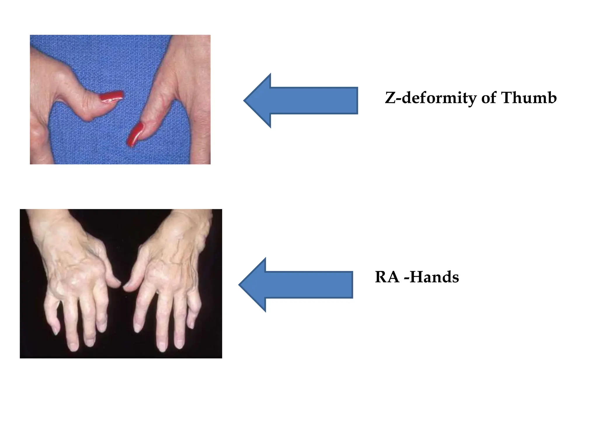 Clinical Pharmacotherapy of Rheumatoid Arthritis | PPTX