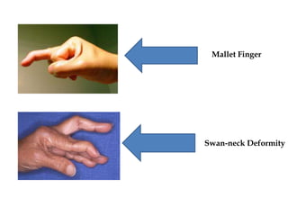 Clinical Pharmacotherapy of Rheumatoid Arthritis | PPTX