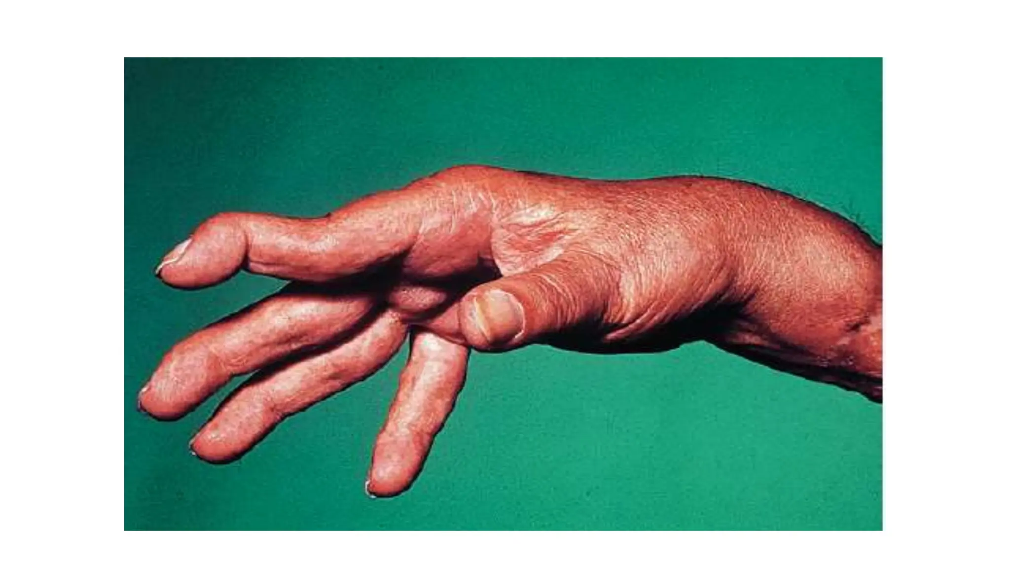 RHEUMATOID ARTHRITIS with dmards classification.pptx