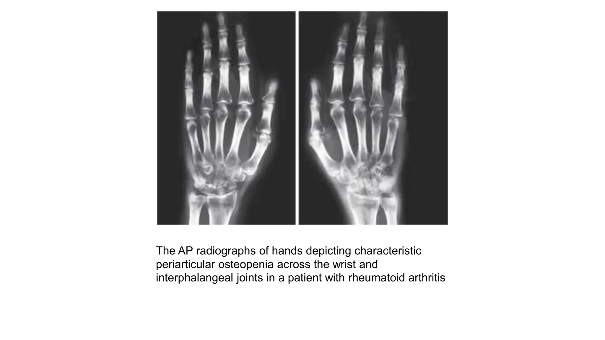RHEUMATOID ARTHRITIS with dmards classification.pptx
