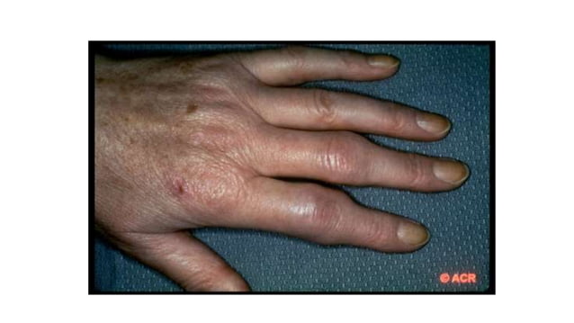 RHEUMATOID ARTHRITIS with dmards classification.pptx