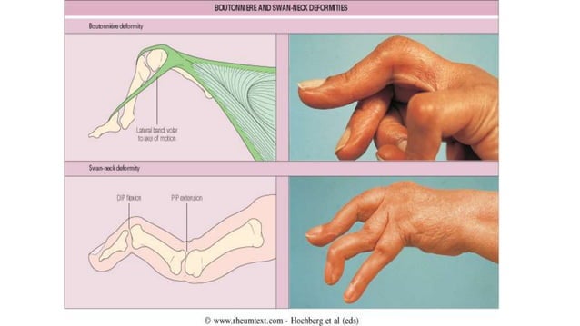 RHEUMATOID ARTHRITIS with dmards classification.pptx