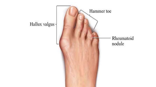 RHEUMATOID ARTHRITIS with dmards classification.pptx