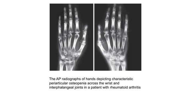 RHEUMATOID ARTHRITIS with dmards classification.pptx