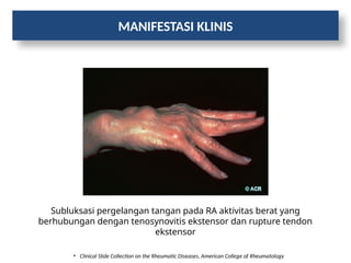 Rheumatoid Arthritis Diagnosis dan Manajemen Terapi | PPTX
