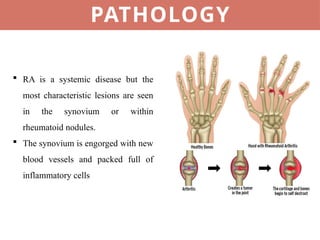 Rheumatoid Arthritis.pptx v | PPTX
