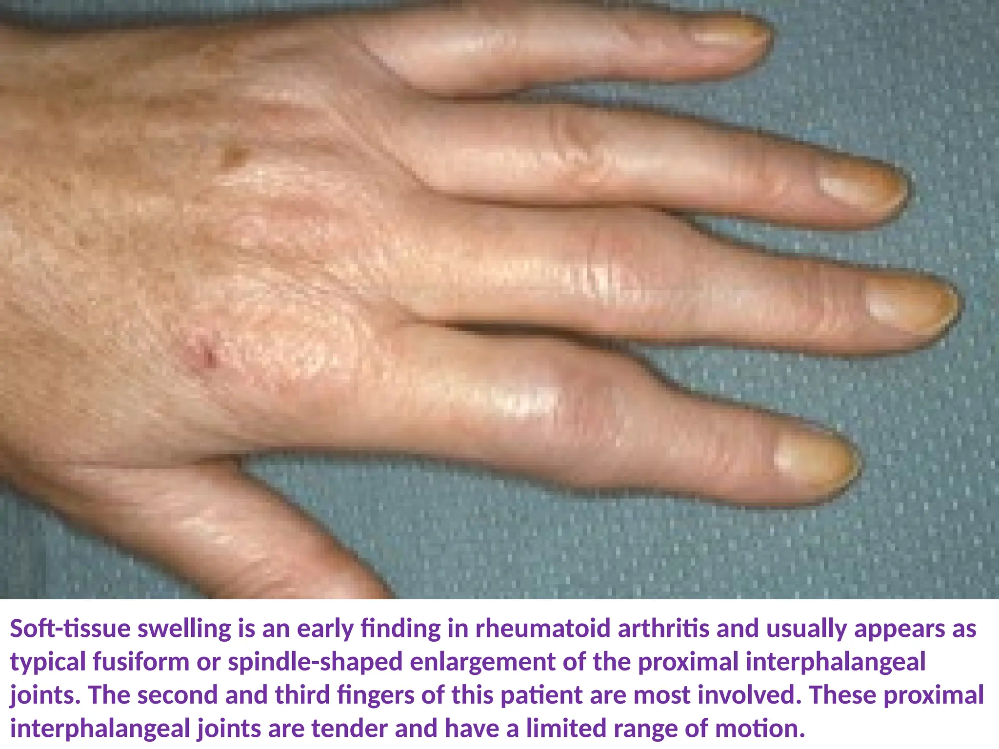 Rheumatoid arthritis.pptx. kiuj, uilki.biop