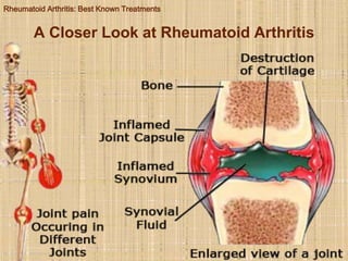 Rheumatoid Arthritis: Best Known Treatments | PPTX