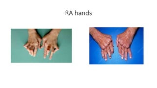 Rheumatoid Arthritis (Nutshell) | PPTX