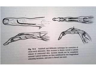 Rheumatoid arthritis hand | PPTX
