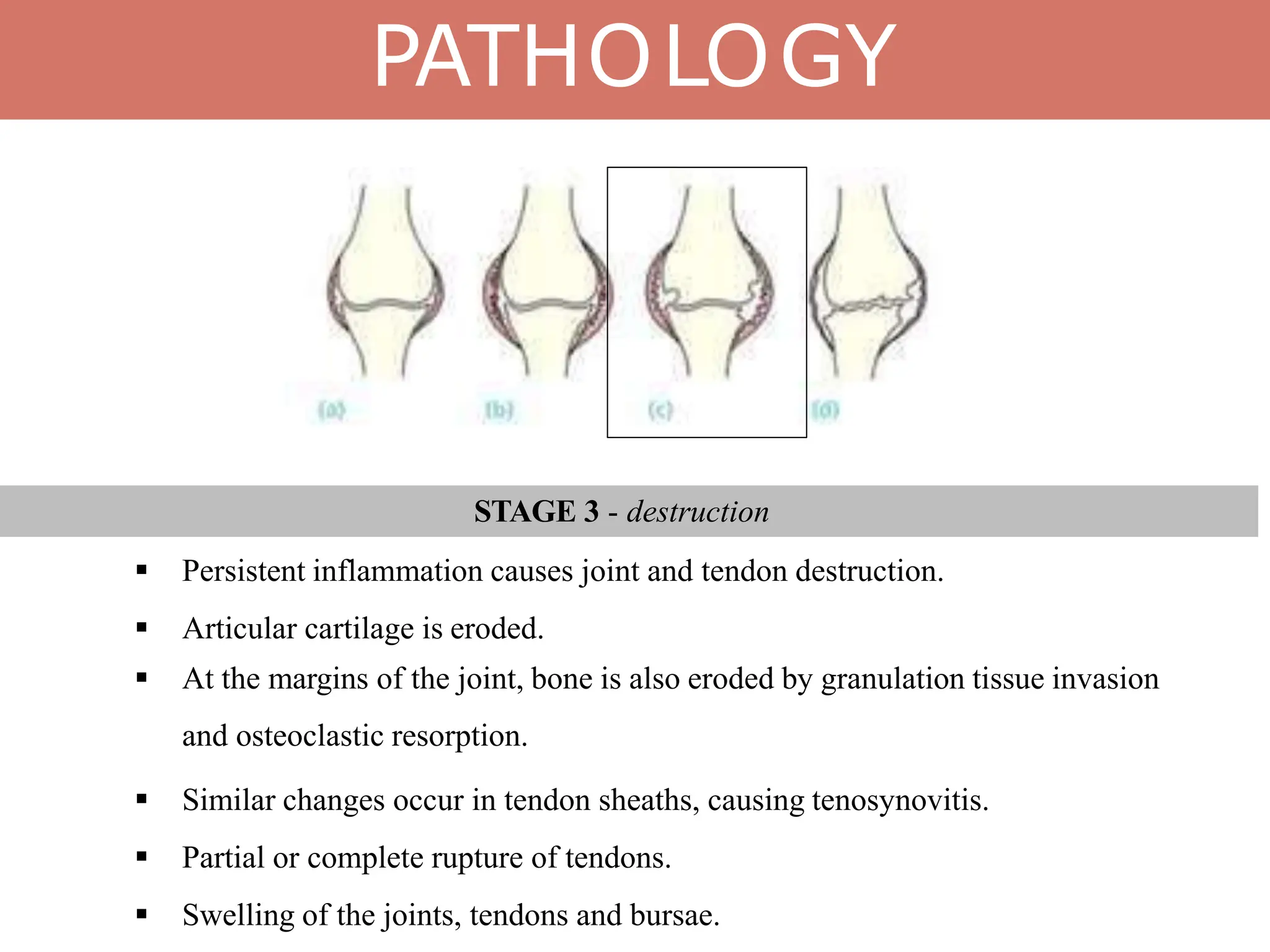 Rheumatoid Arthritis (2).pptx an approach to management | PPTX