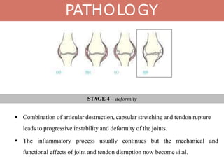 Rheumatoid Arthritis (2).pptx an approach to management | PPT
