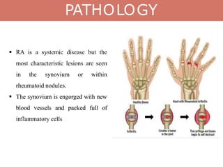 Rheumatoid Arthritis (2).pptx an approach to management | PPTX