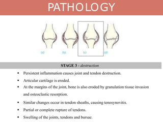 Rheumatoid Arthritis (2).pptx an approach to management | PPT