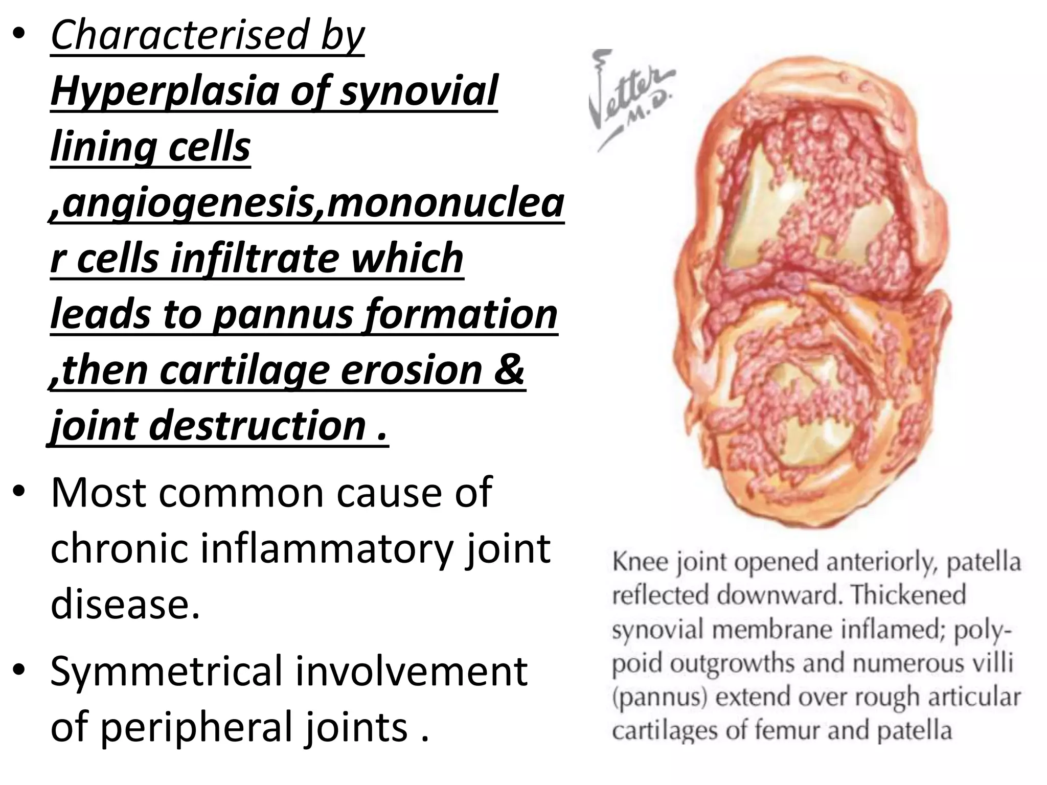 Rheumatoid arthritis | PPTX