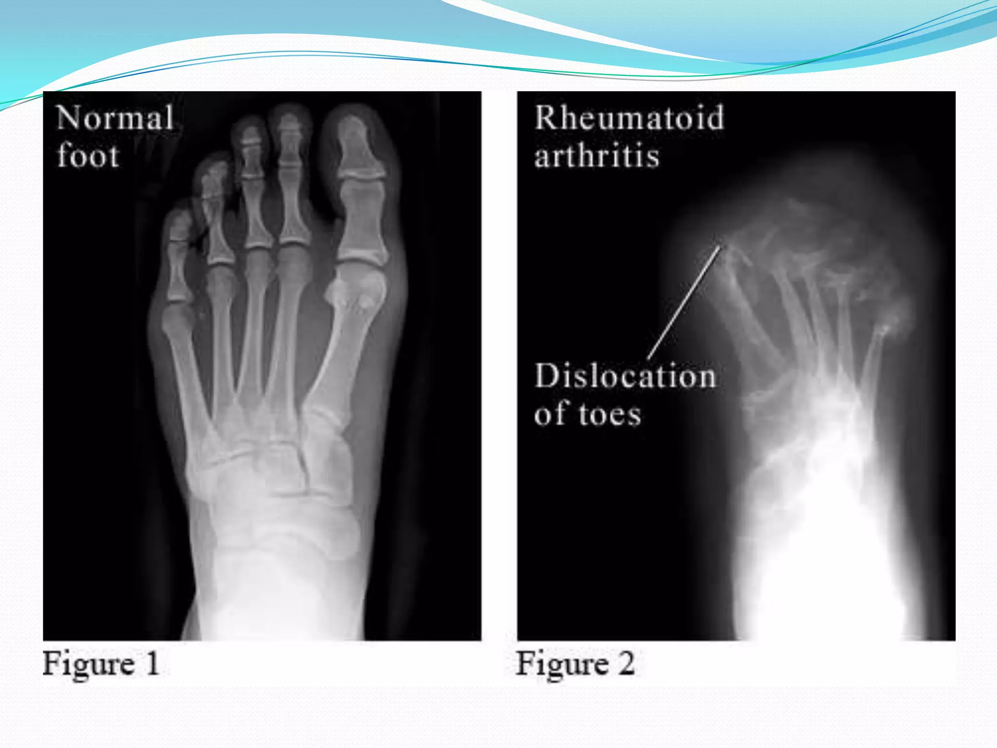 Rheumatoid arthritis and osteoarthritis | PPTX