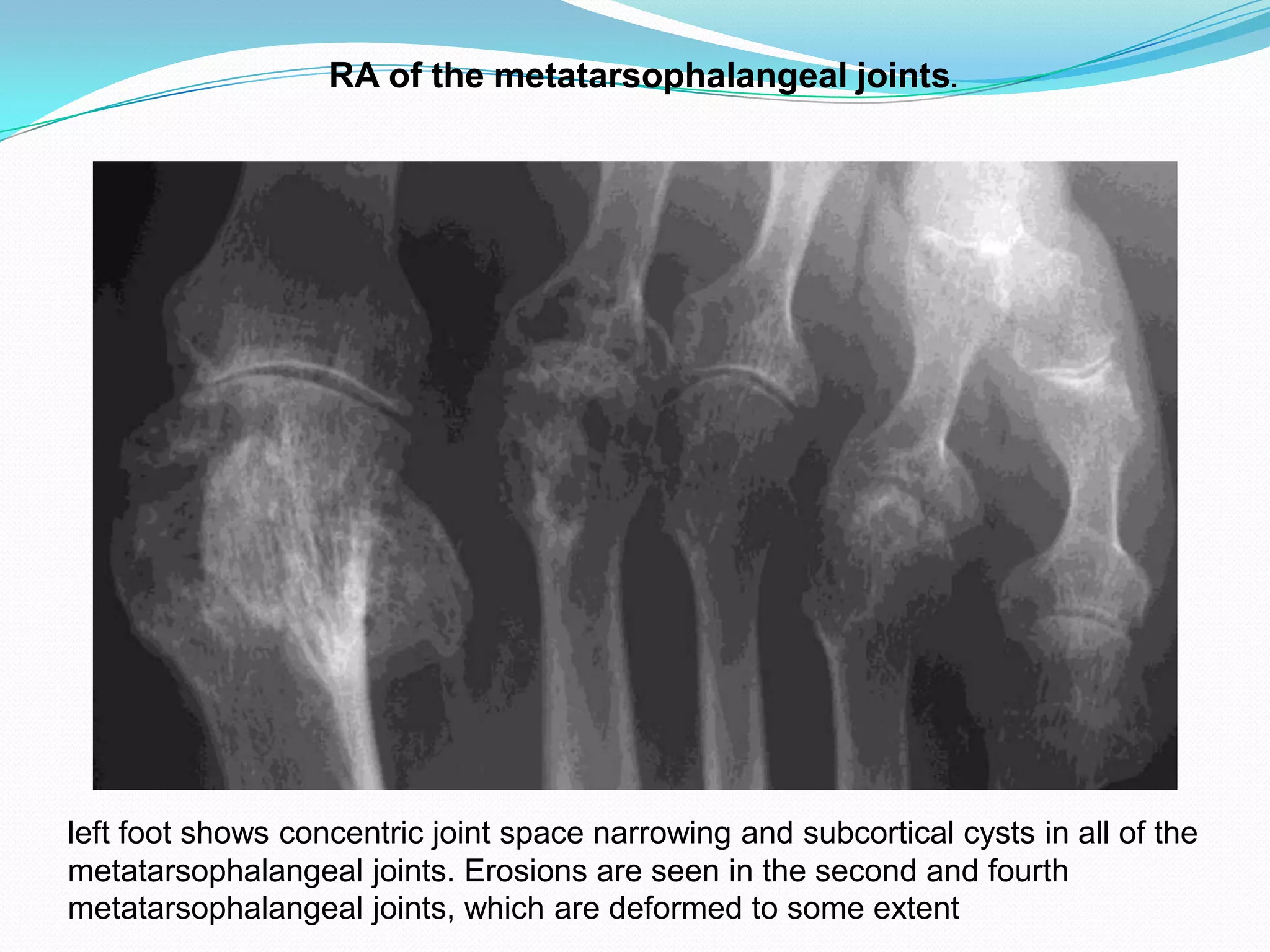 Rheumatoid arthritis and osteoarthritis | PPTX