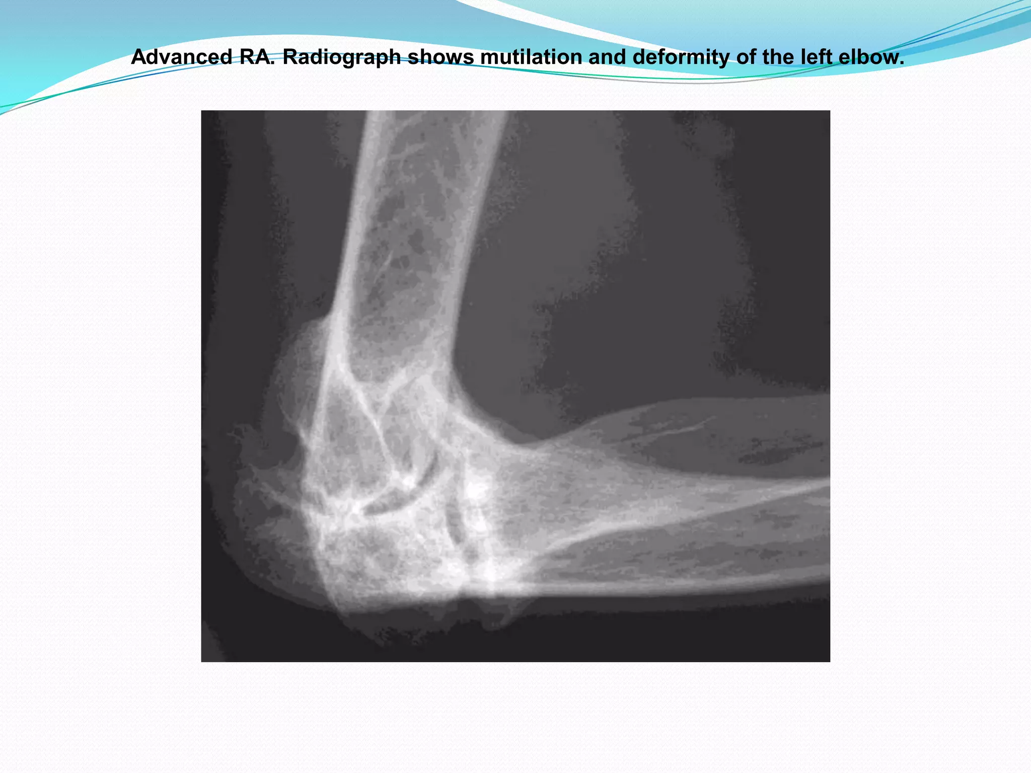 Rheumatoid arthritis and osteoarthritis | PPTX