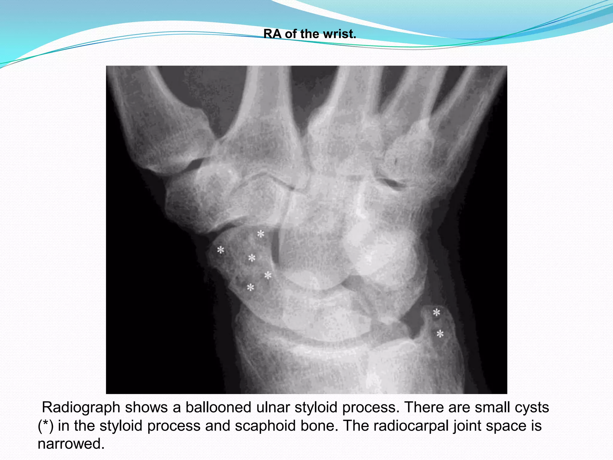 Rheumatoid arthritis and osteoarthritis | PPTX