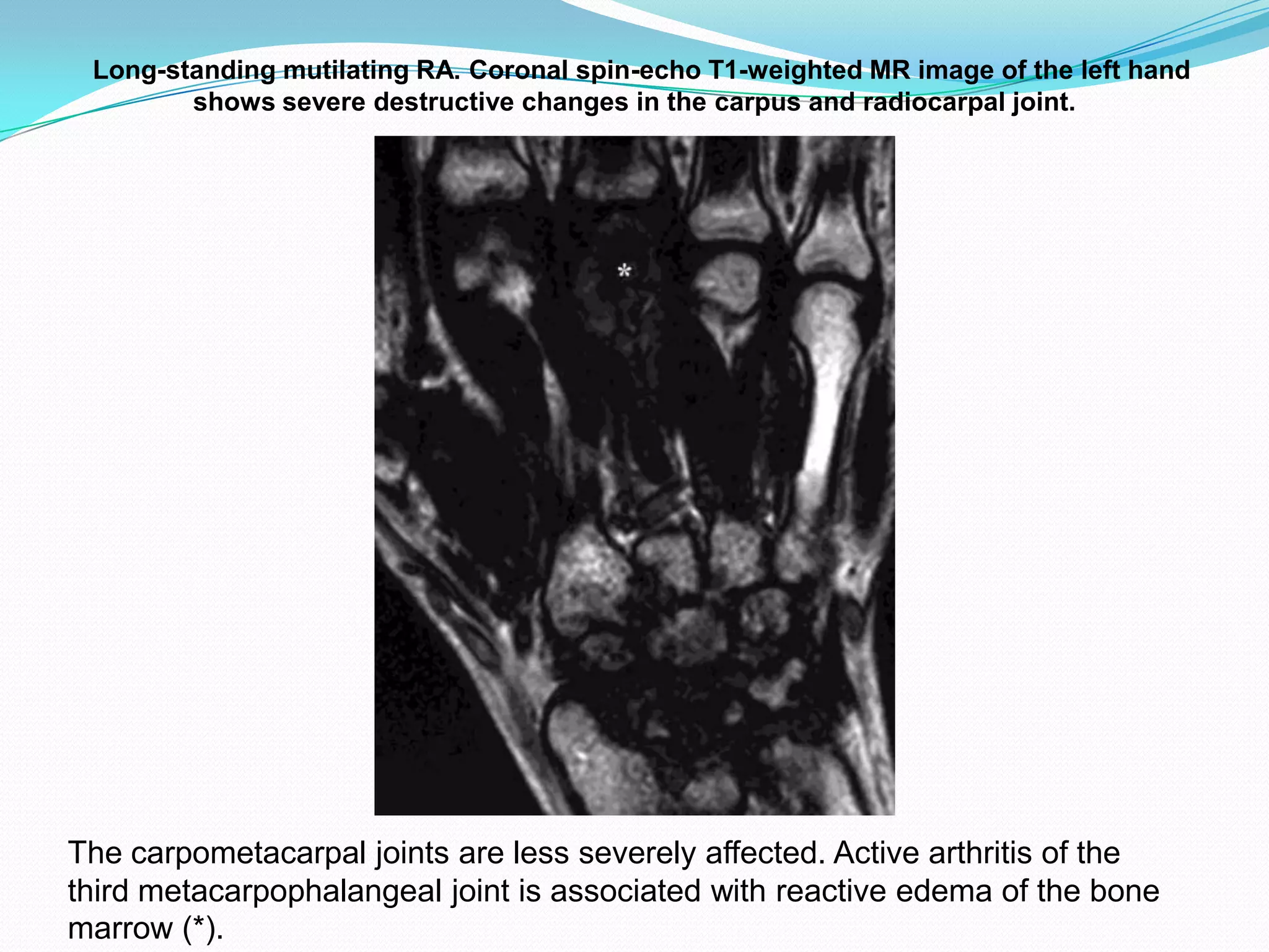 Rheumatoid arthritis and osteoarthritis | PPTX