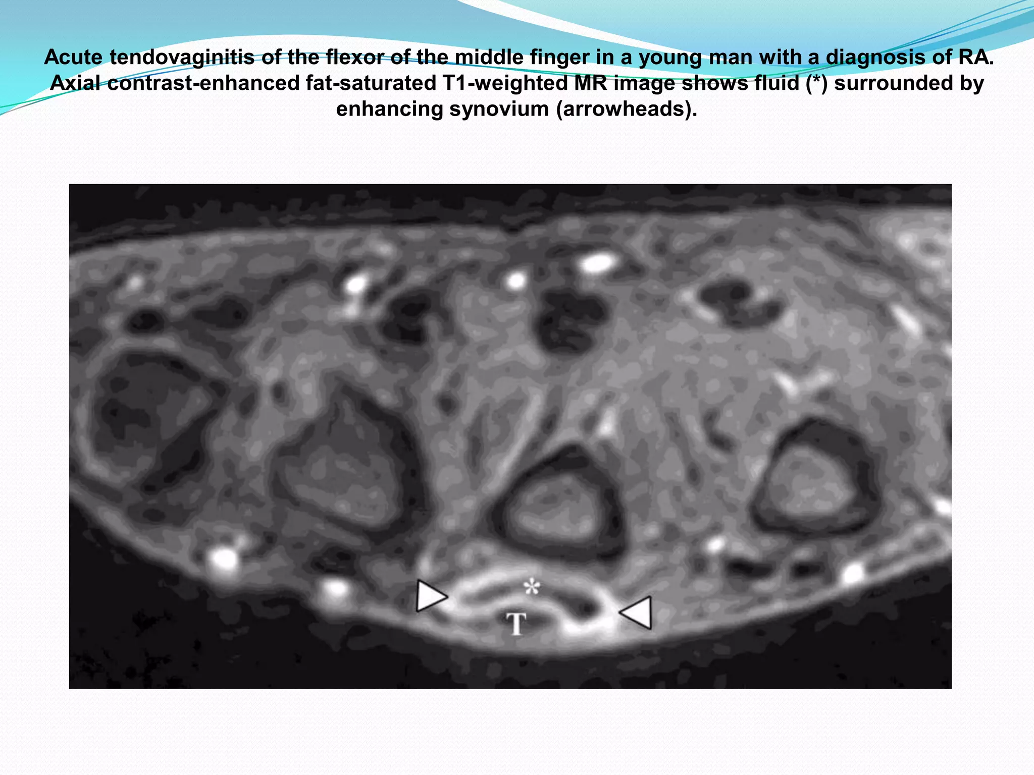 Rheumatoid arthritis and osteoarthritis | PPTX