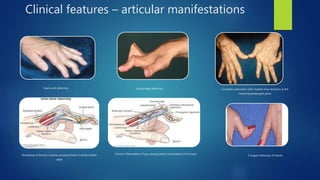 Rheumatoid arthritis | PPTX
