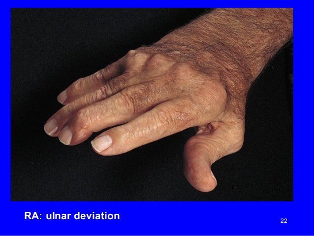 Rheumatoid Arthritis Drabdallah