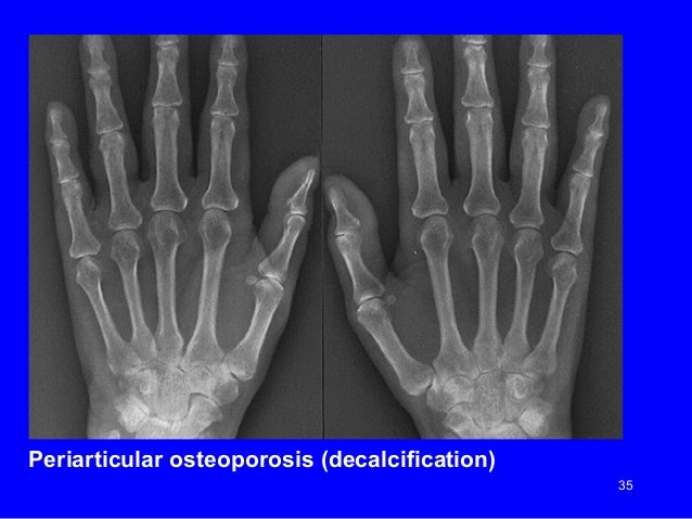 Rheumatoid arthritis dr.abdallah